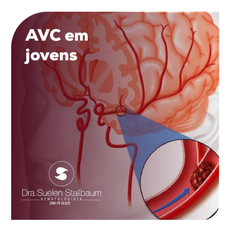 AVC em jovens: entenda quais são os riscos e cuidados - Dra. Suellen ...
